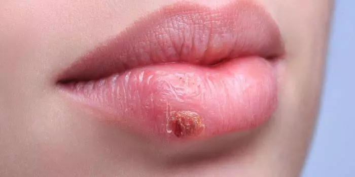 Herpes auf der Lippe des Mädchens