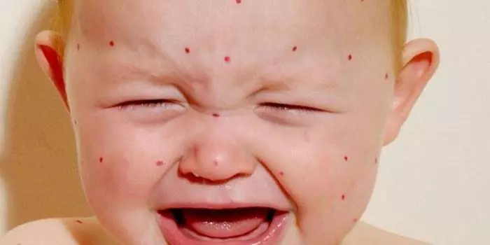 The child has chickenpox