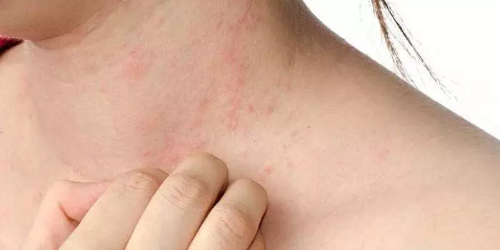 Allergic itching of the skin
