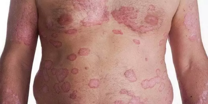 Adamyň bedenine psoriatik nyşanlar