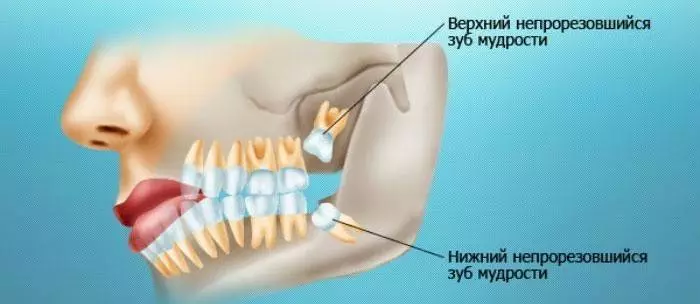 Kako ublažiti zubobolju kod kuće - lijekovi, narodni lijekovi