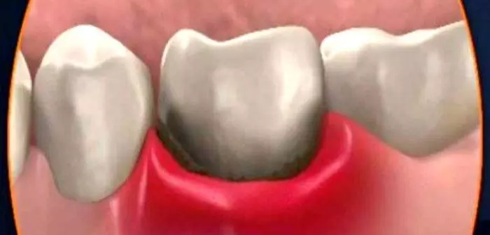 Mishrat e dhëmbëve të fryrë dhe të lënduar