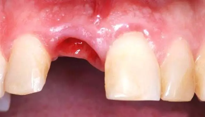 Dhimbje pas nxjerrjes së dhëmbit