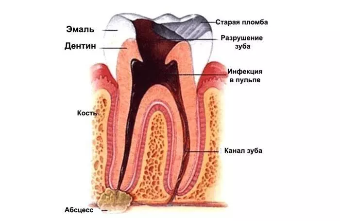 Shkaku i dhimbjes në një dhëmb të mbushur