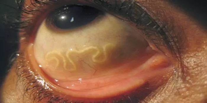 Un parasito no ollo humano