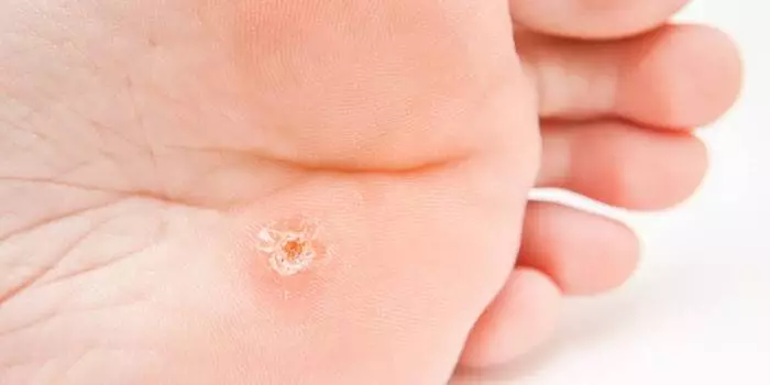 Plantar warts