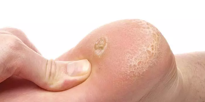 Plantar warts