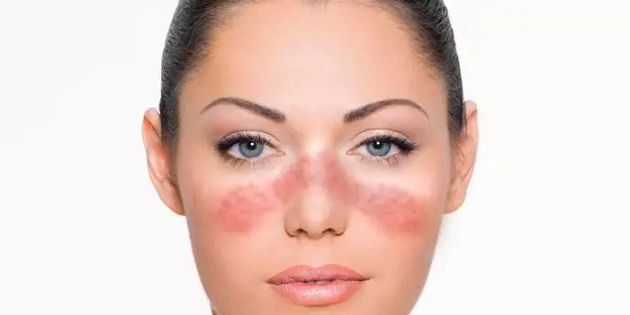 Lupus ban đỏ trên khuôn mặt của một cô gái