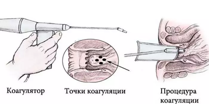 Інфрачырвоная каагуляцыя геморроідальные вузлоў