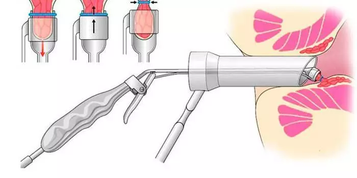 Zowonekera kunja kwa hemorrhoidal ligation