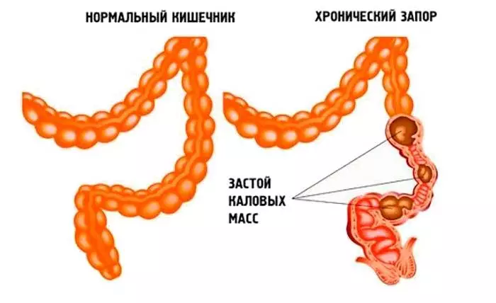 Хранічны запор на схеме