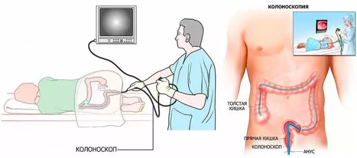 colonoscopy