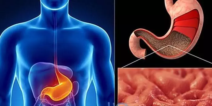 Emberi gyomor és a felületes gastritis megnyilvánulásai