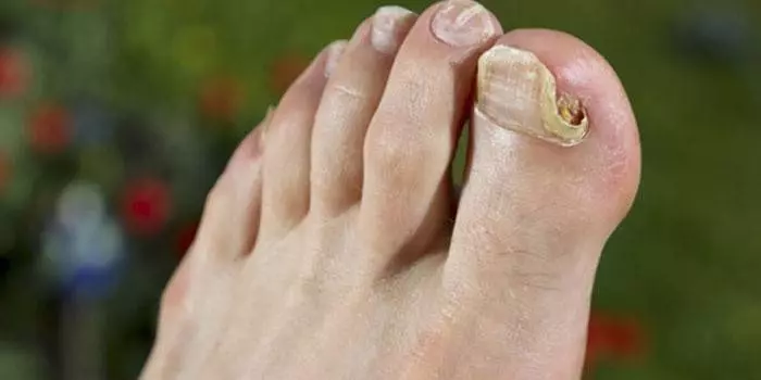 Uñas dos pés infectadas por fungos