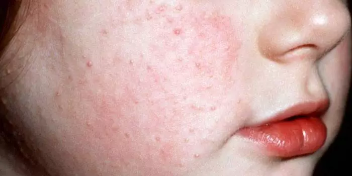 Follicular hyperkeratosis on the face of a girl