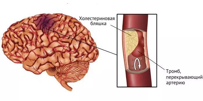 Ischemic stroke cerebral