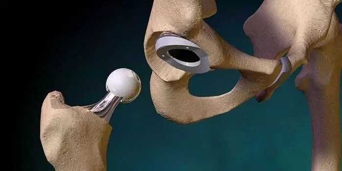 Hip sib koom endoprosthesis