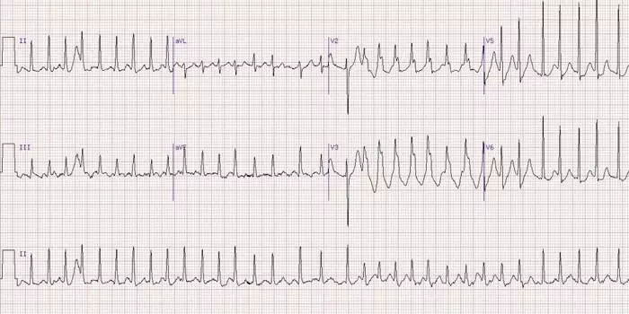 Heartürek ritminiň bozulmagy kardiogramma