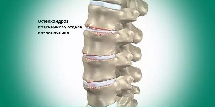 Osteokondwoz nan kolòn vètebral la lonbèr