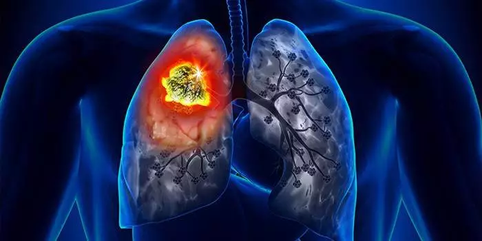 Schema tumorală a cancerului pulmonar