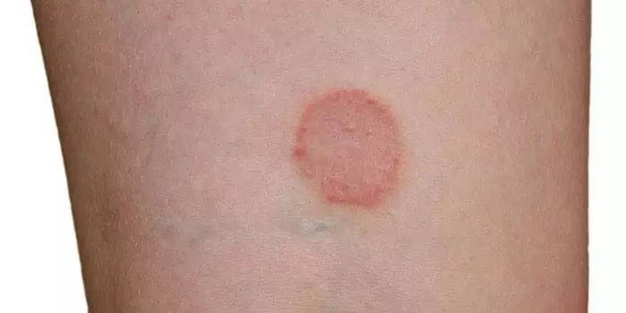 Pityriasis အရေပြားပေါ်တွင်ပန်းရောင်ရှိသည်