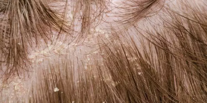 Des morceaux de peau secs sur les cheveux