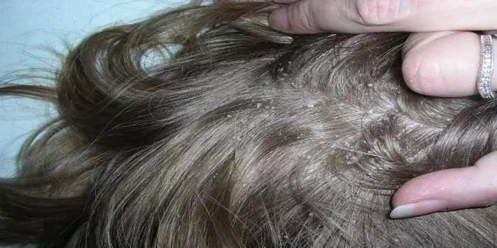 Manifestations de séborrhée sèche sur le cuir chevelu d'une femme