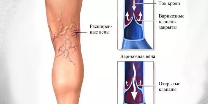 Varicose veins a kafafu