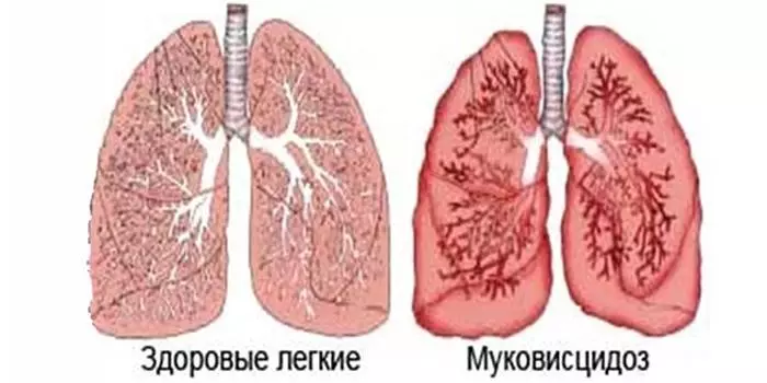 Paru-paru sihat dan terjejas oleh fibrosis sista, skema