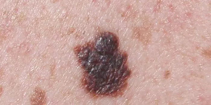Dəridə melanoma