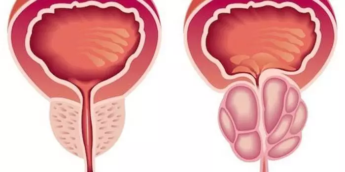 Sog'lom prostata va prostata yallig'lanishining diagrammasi