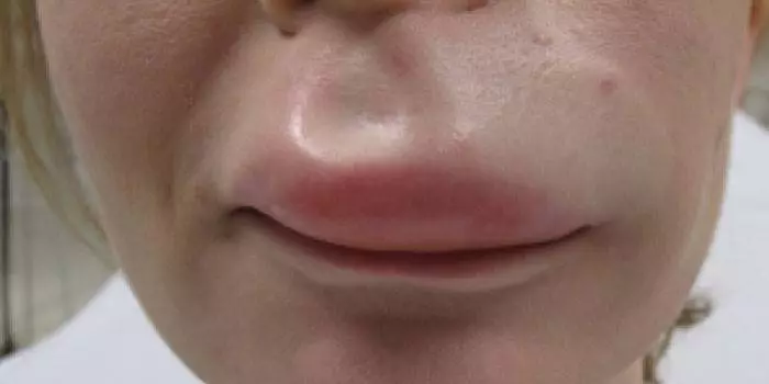 人間の上唇のクインケ浮腫