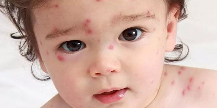 Projev planých neštovic u dítěte