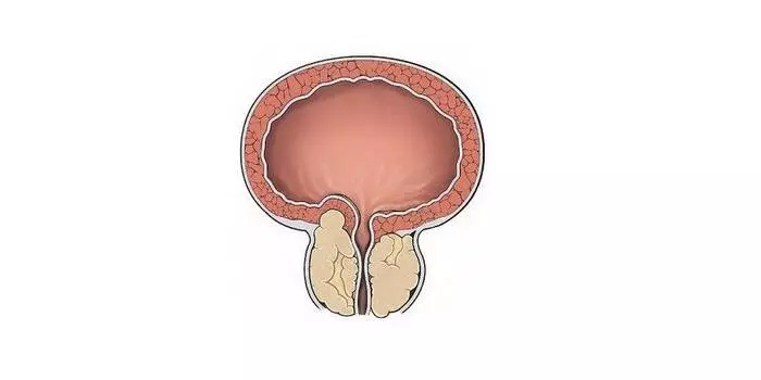 Prostate cancer, eserese