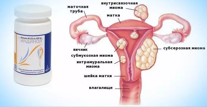 Indinol y tipos de fibromas uterinos