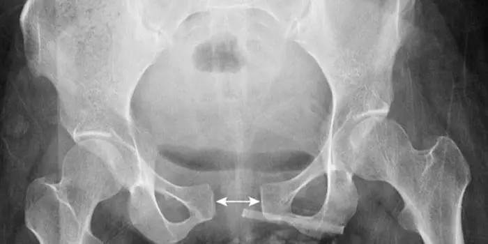 Рентгенография на разминаване на тазовите кости