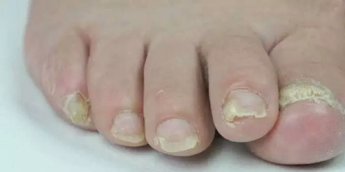 Onychomycosis iinzipho