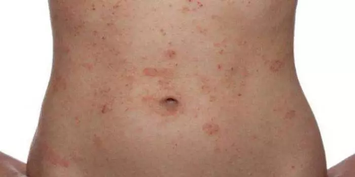 Dermatitis alergi pada tubuh