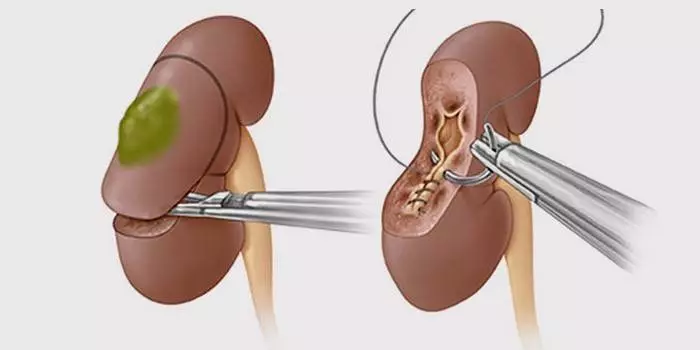 Nefrektomia - operacja usunięcia nerki lub jej części