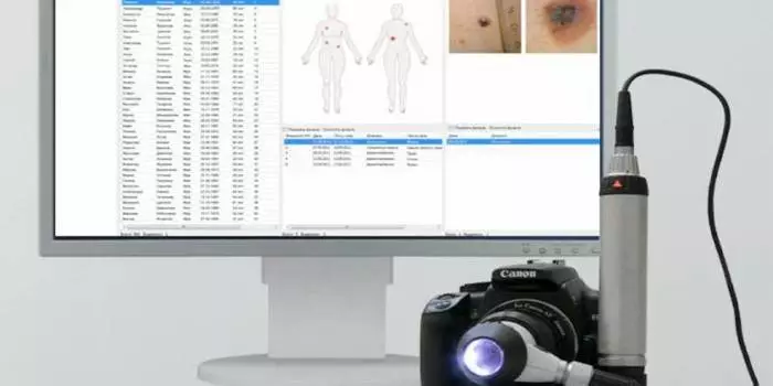 Qalabka dermatoscopy