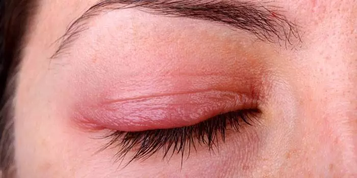 Inflammert øvre øyelokk hos en kvinne