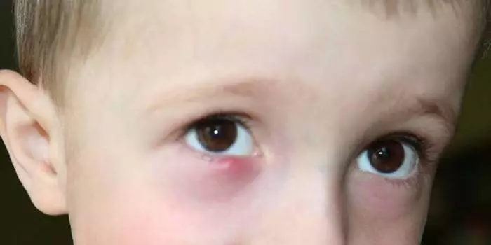 Betent nedre øyelokk hos et barn