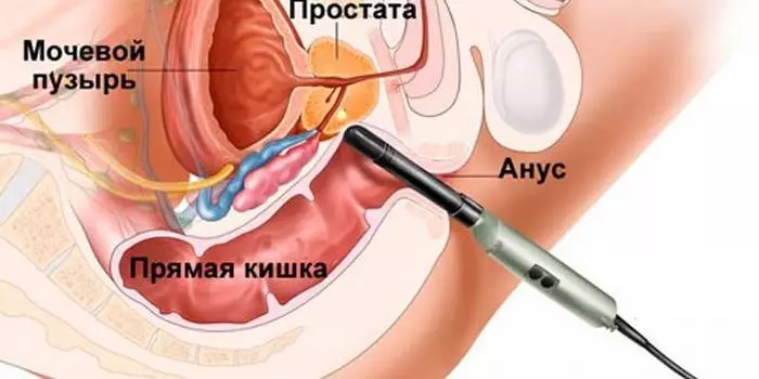 Gambar proses biopsi prostat