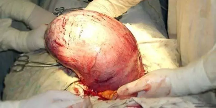 Surgery to remove uterine sarcoma