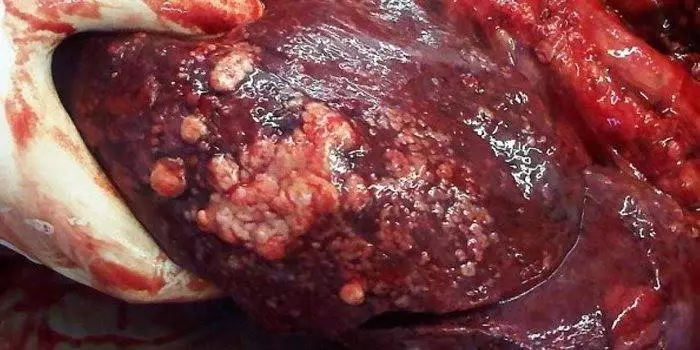 Lung Sarcoma Disease