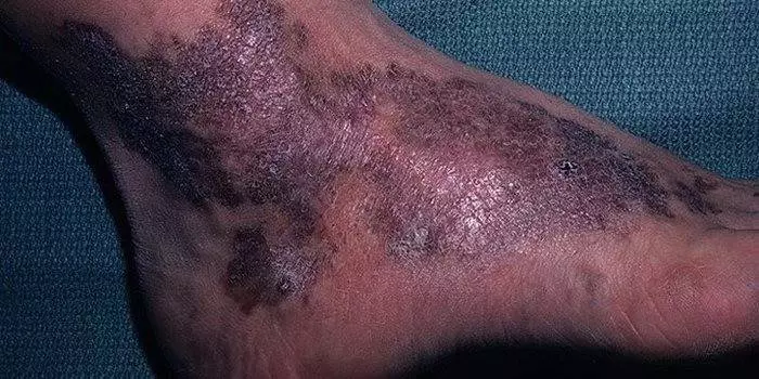 What does a skin sarcoma look like?