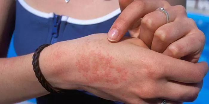 The manifestation of an allergic rash on the skin of the hand