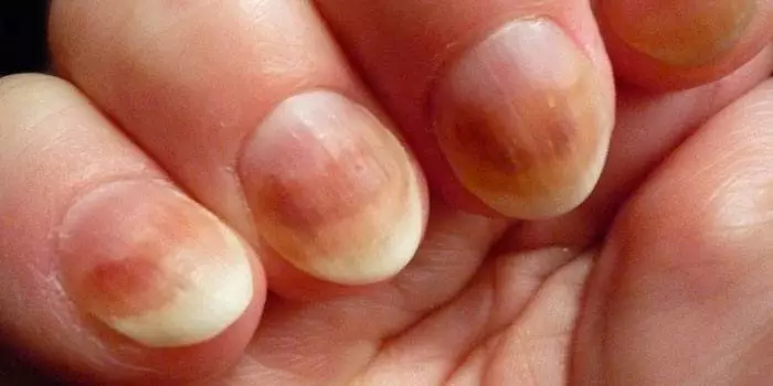 Candidiasis of the nails