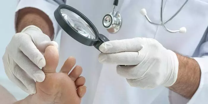 Diagnozo de pieda fungo