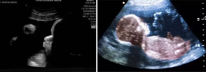 Ultrasound ya tumbo katika wiki 39 za ujauzito